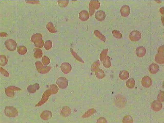 Level 4 - Rode bloedbeeld (plaatje) - Haematology - Memrise Level 4 - Rode bloedbeeld (plaatje) - Haematology - Memrise