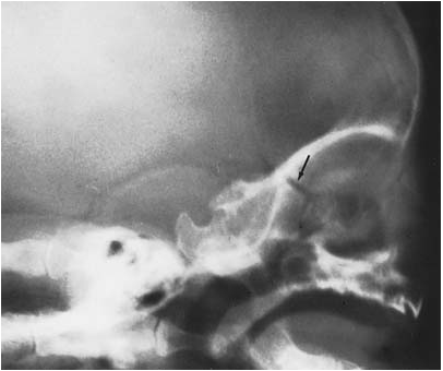Zygomaticofrontal Suture Ct
