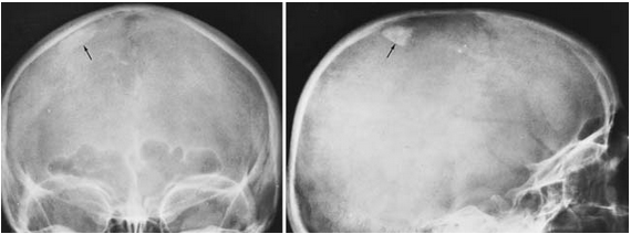 Habenular Calcification