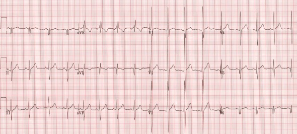 Level 3 - 16 - 30 - EKG - Memrise