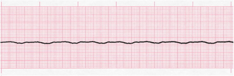 Level 1 - 1 - 10 - ECG - Memrise