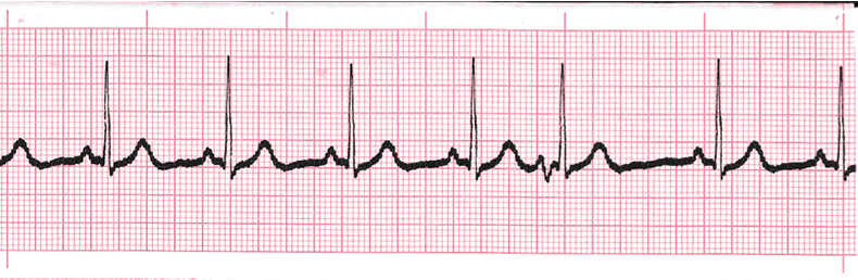 Level 3 - 21 - 30 - ECG - Memrise