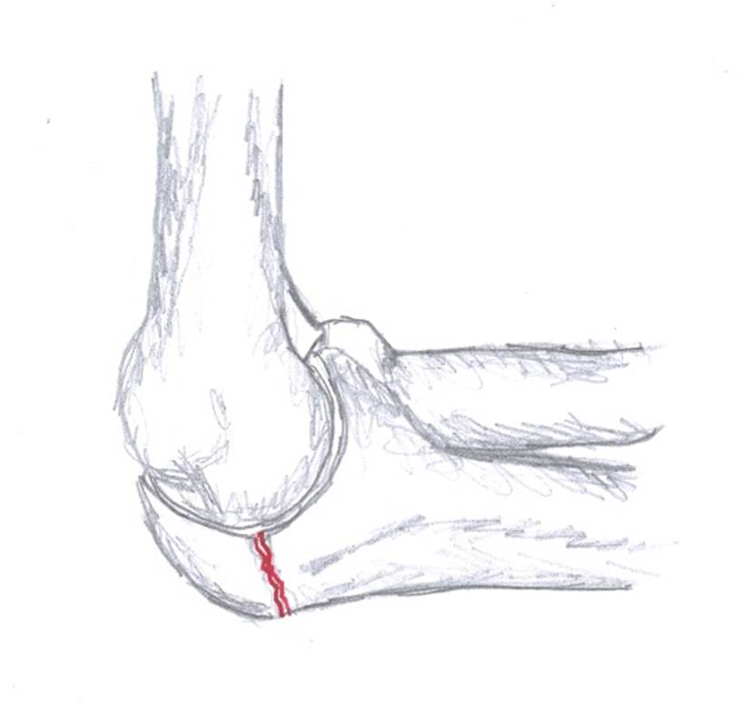 Mayo Classification System Of Olecranon Fractures