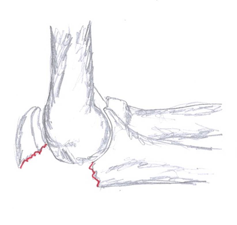 Mayo Classification System Of Olecranon Fractures