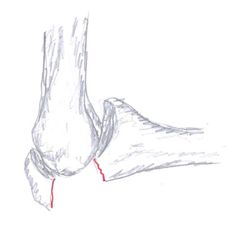 Mayo Classification System Of Olecranon Fractures