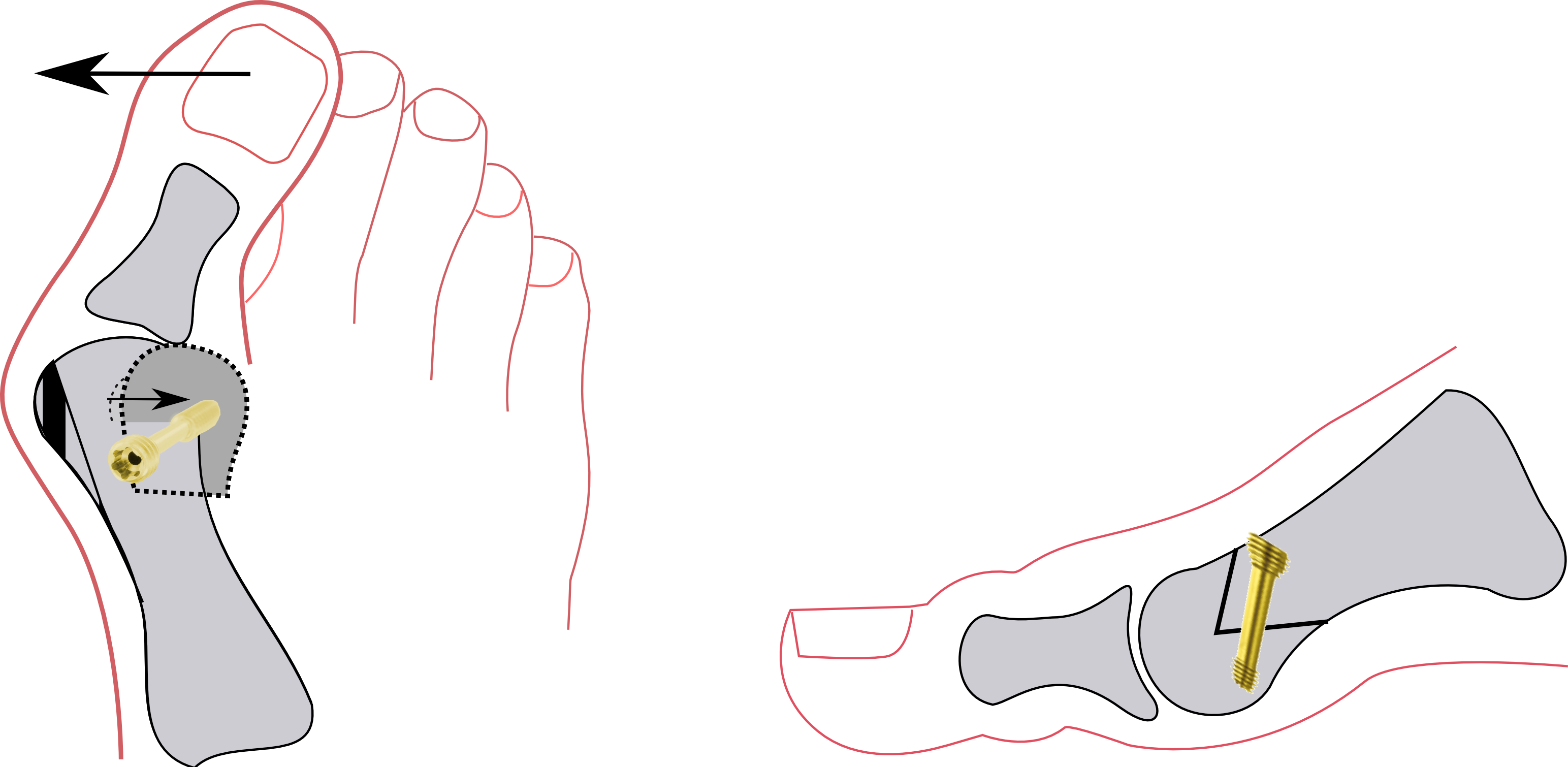 Level 7 - Common Osteotomies of the Foot - Foot Anatomy - Memrise