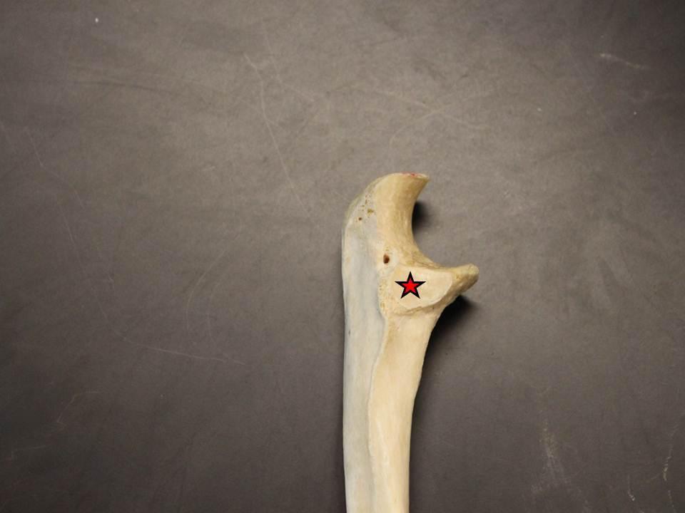 Radial Notch Una